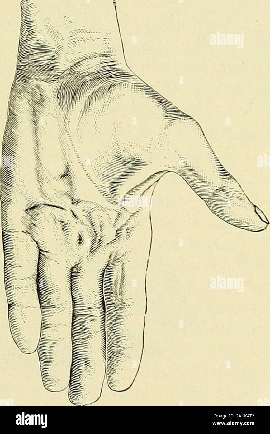 Palmar fascia hi-res stock photography and images - Alamy