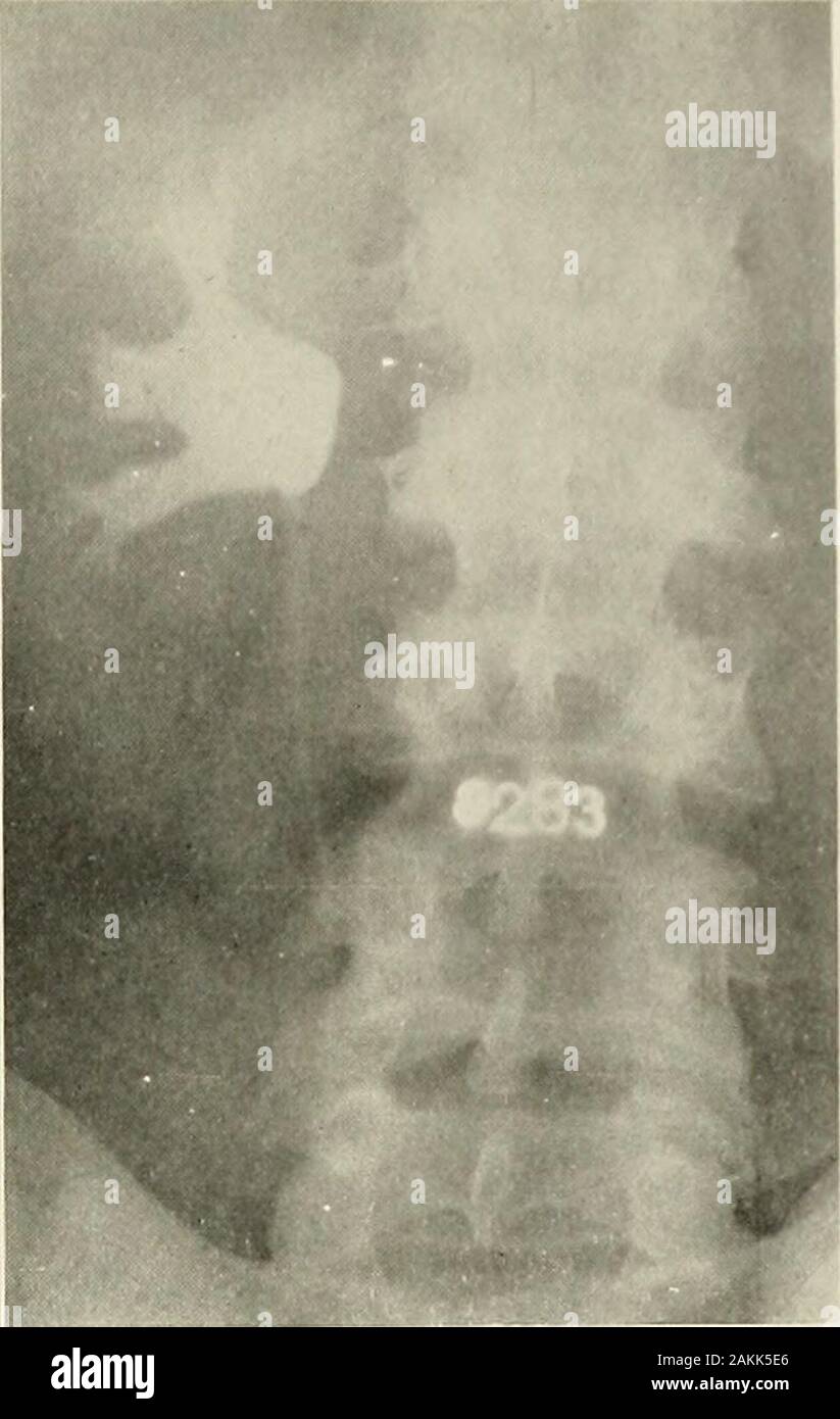 Pyelography (pyelo-ureterography) a study of the normal and pathologic ...