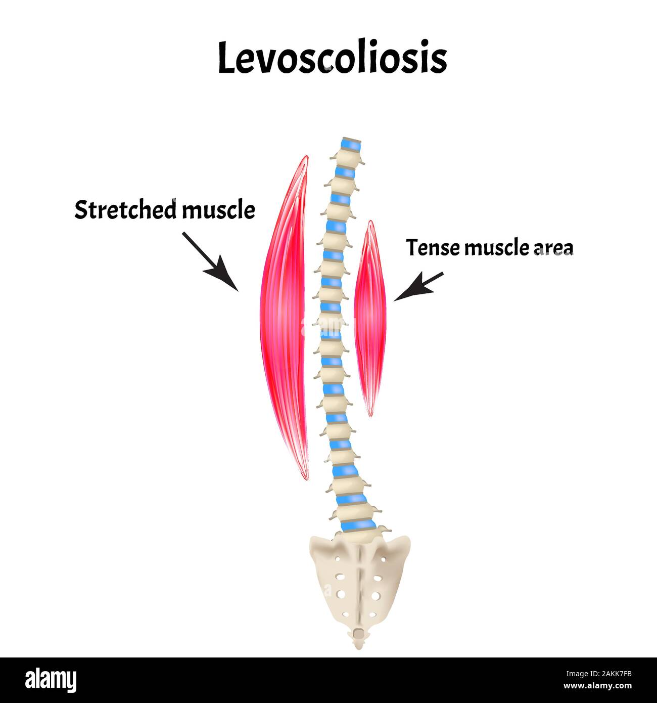 Left-sided scoliosis. Levoscoliosis. Muscles and spine. Spinal ...
