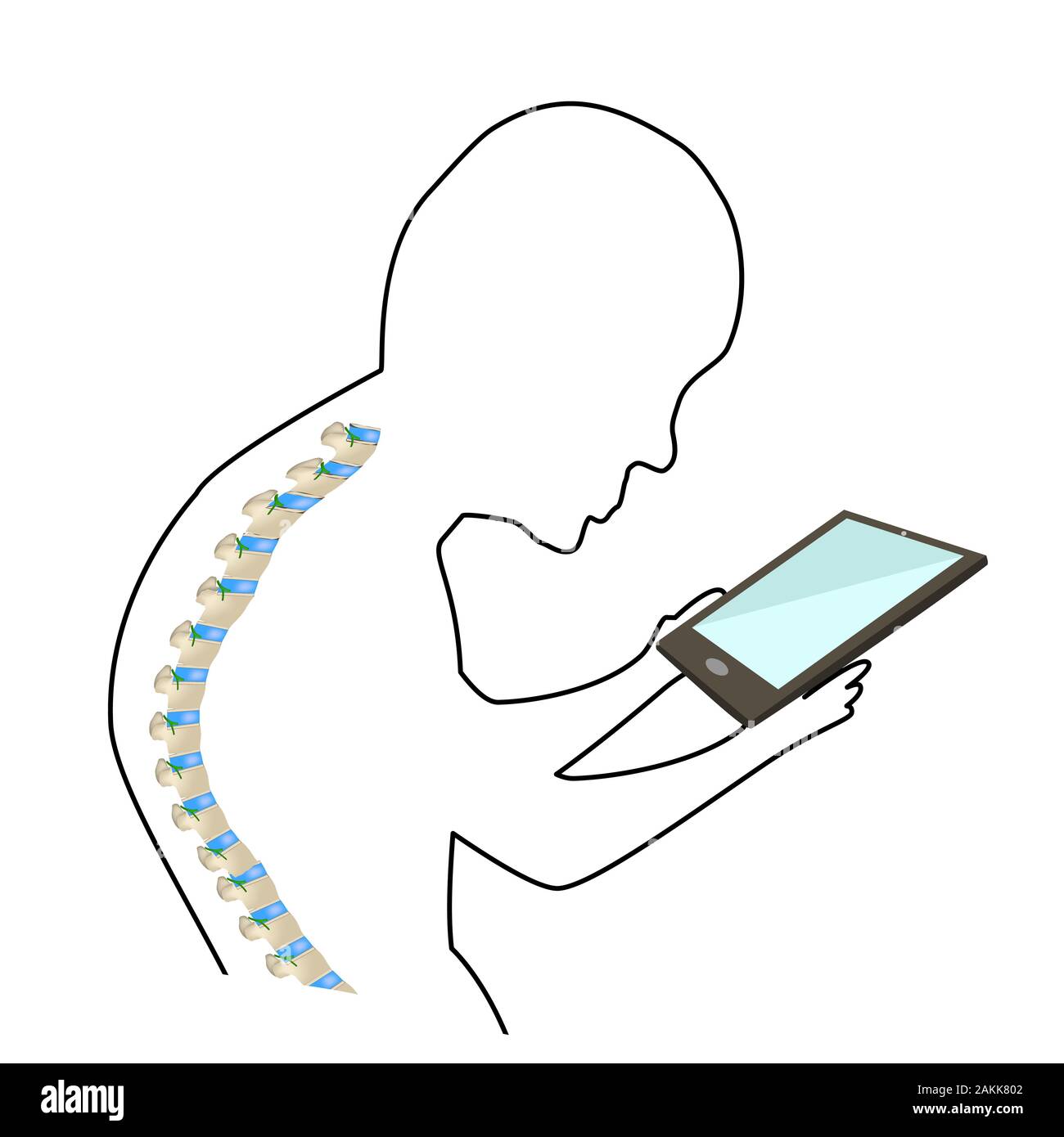 Text Neck Syndrome. Spinal curvature, kyphosis, lordosis of the neck ...