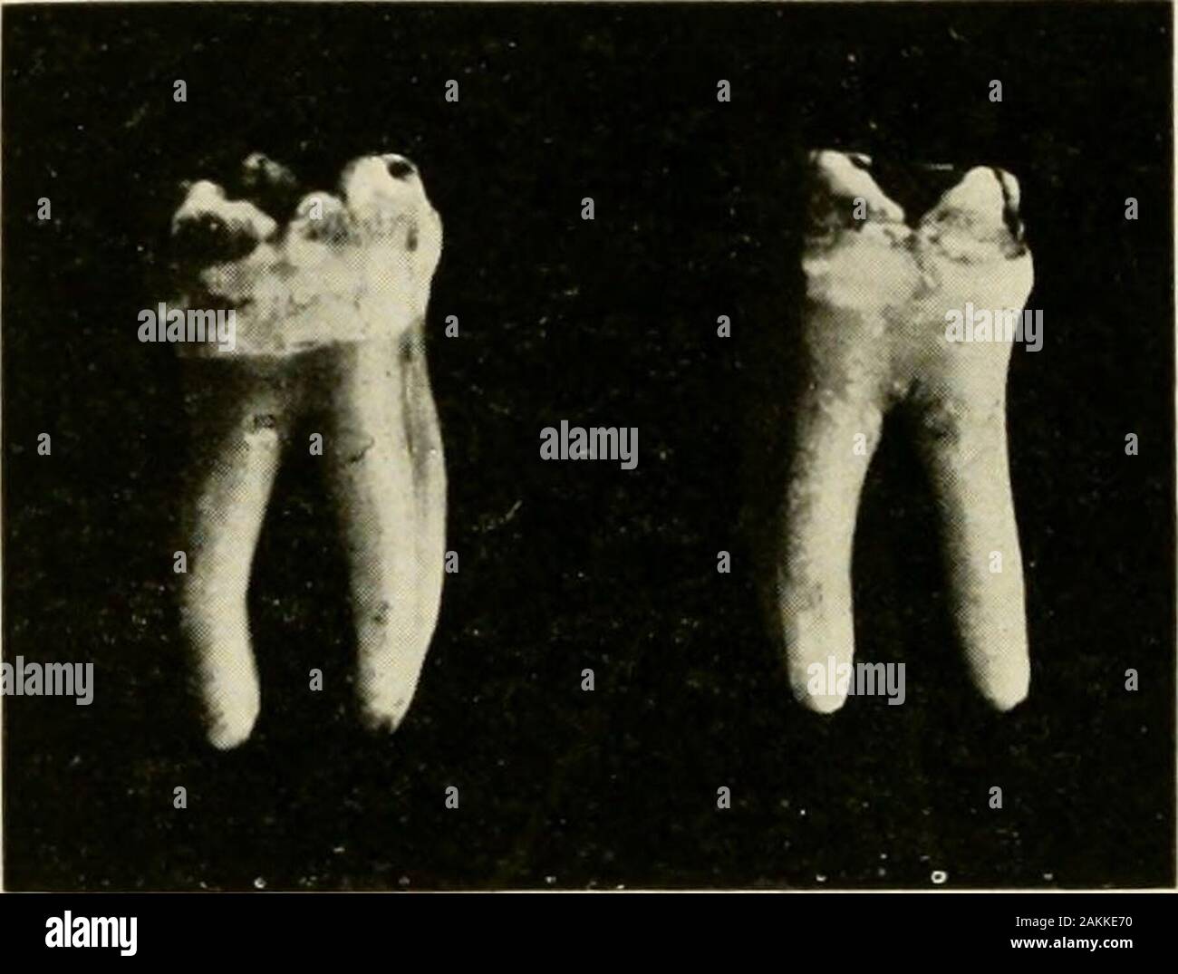 Dental crown development hi-res stock photography and images - Alamy