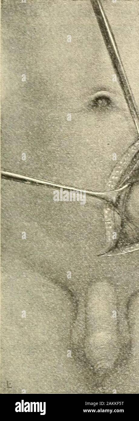 Midline incision hi-res stock photography and images - Alamy