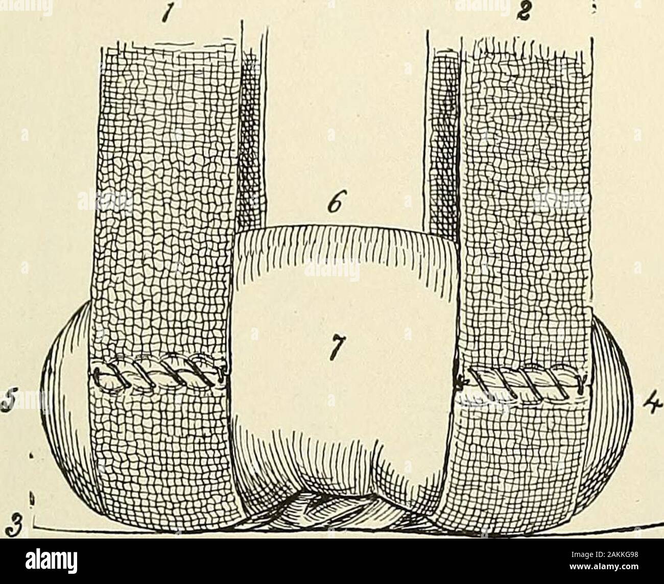 Lumbar incision hi-res stock photography and images - Alamy