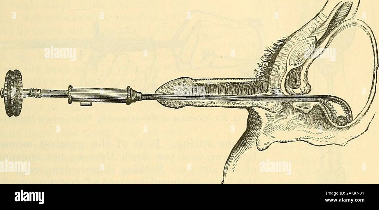 Bladder stone operations hi-res stock photography and images - Alamy