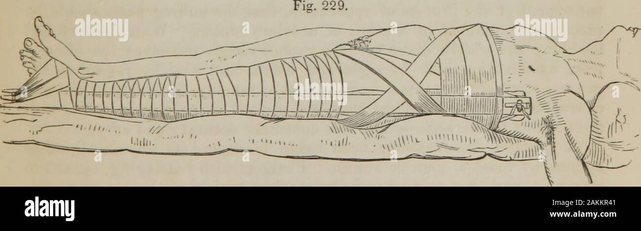 The principles of surgery . Splint, ready for application. The long ...