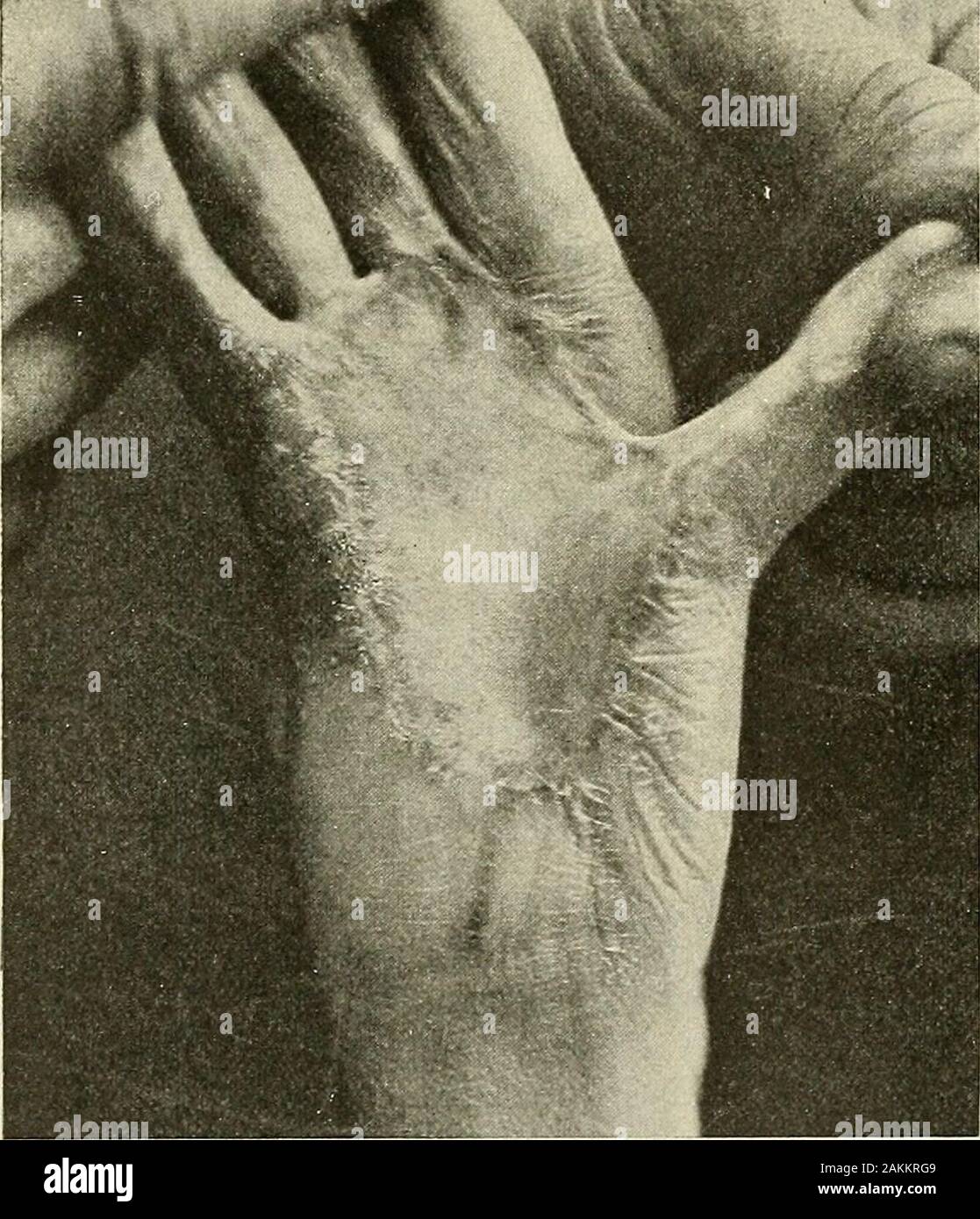 Reverdins grafts hi-res stock photography and images - Alamy