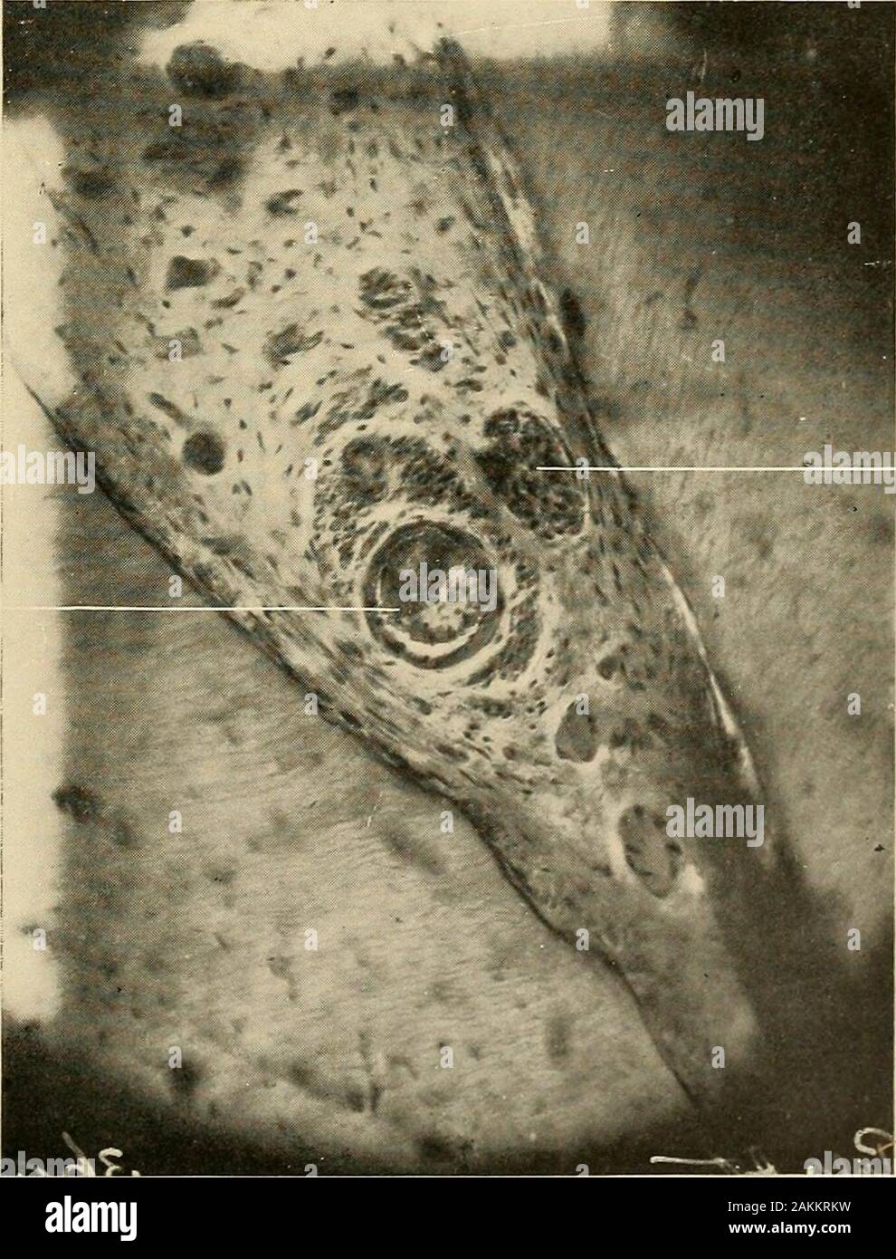 Principles and practice of operative dentistry . Fig. 638.—Fibroid ...