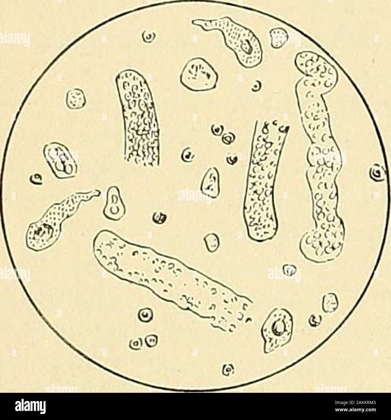 Hyaline Cast In Urine
