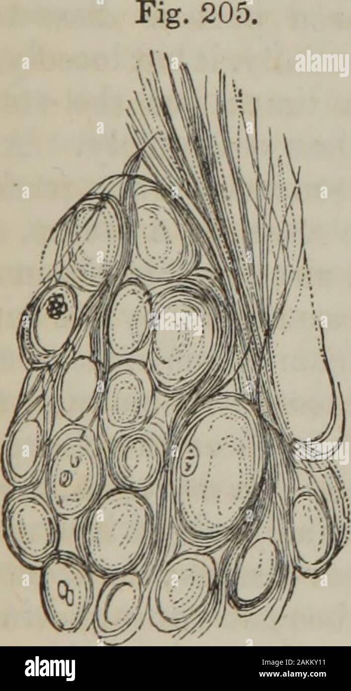 The principles of surgery . Section of a neuroma; three nervoustrunks ...