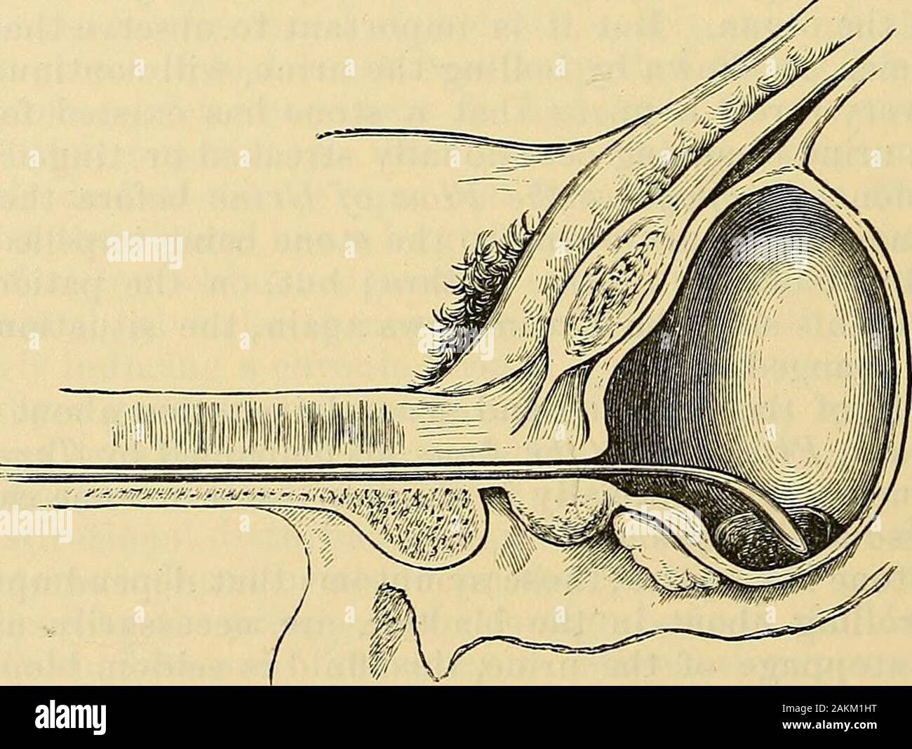 Bladder stone operations hi-res stock photography and images - Alamy
