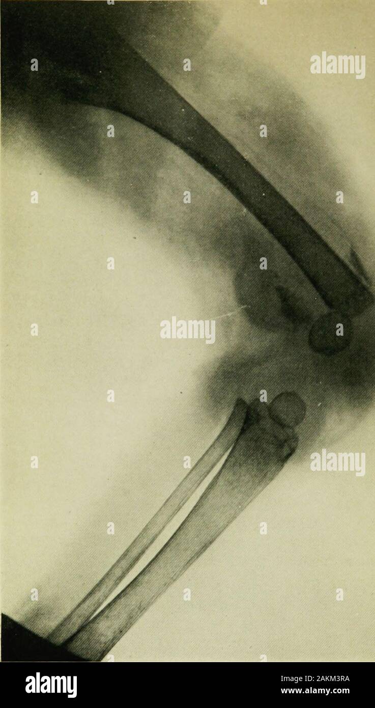 Scurvy past and present . Fig. 16.—Infant 11 months old. Separation of ...