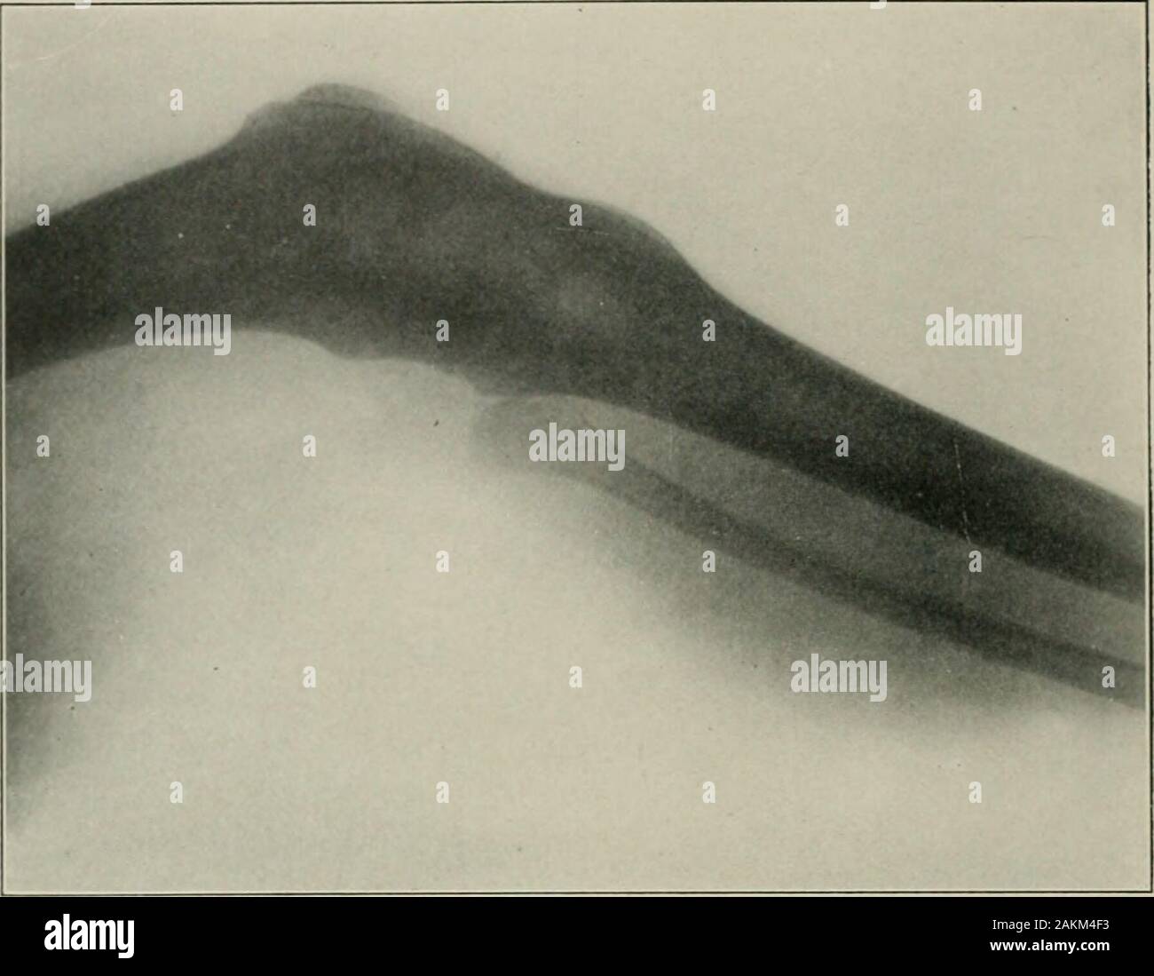 Ankylosis hi-res stock photography and images - Alamy