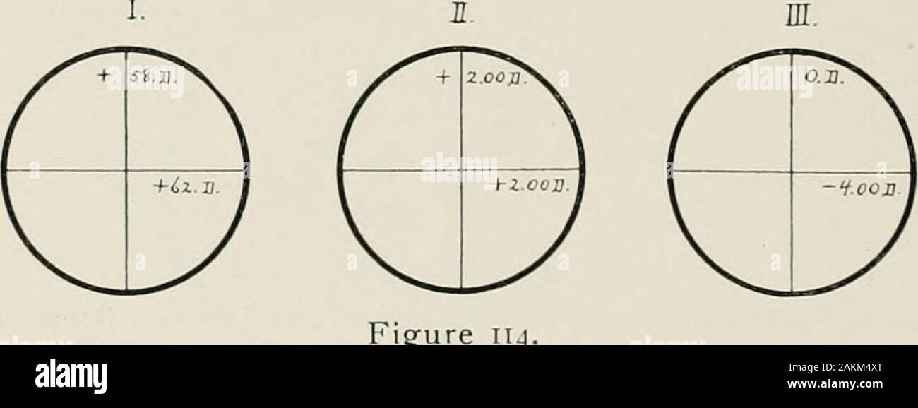 Ocular refraction and the shadow test . through this meridian. Figure ...