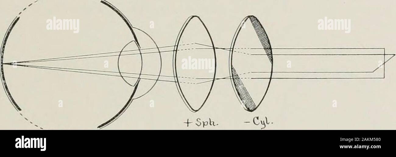 Hypermetropic hi-res stock photography and images - Alamy