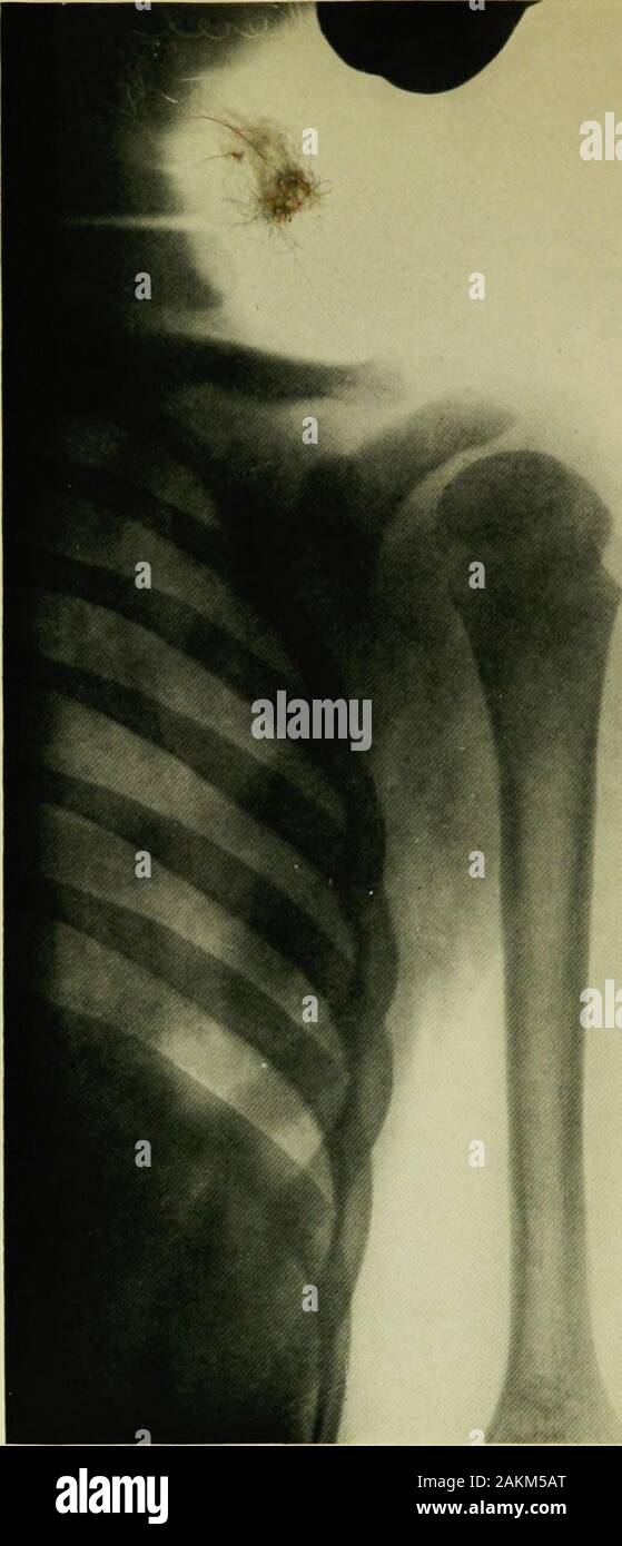 Scurvy past and present . Fig. 6.—Posterior-anterior view of shoulder ...