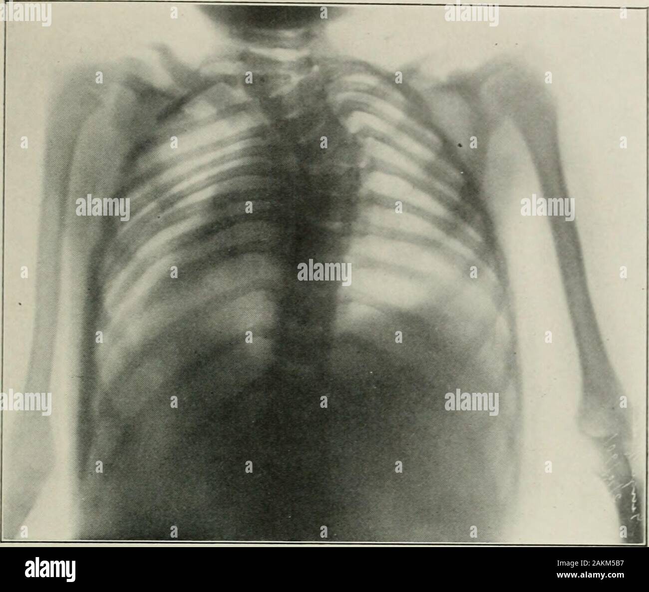 Congenital dislocation of the hip hi-res stock photography and images ...