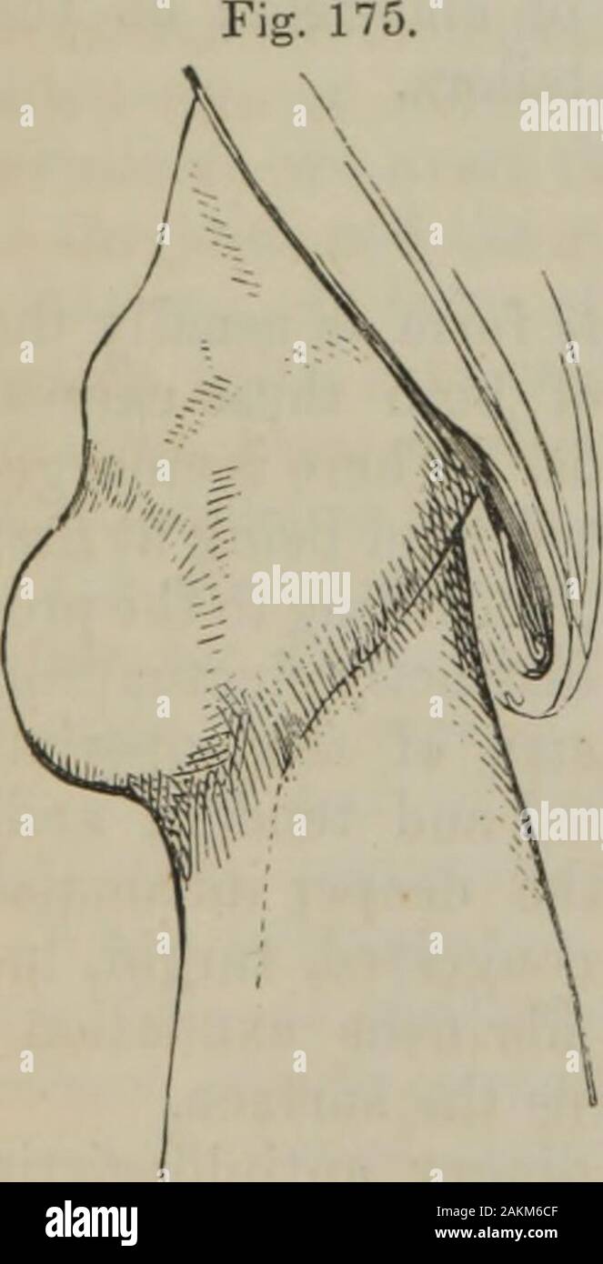 Abscess incision hi-res stock photography and images - Alamy