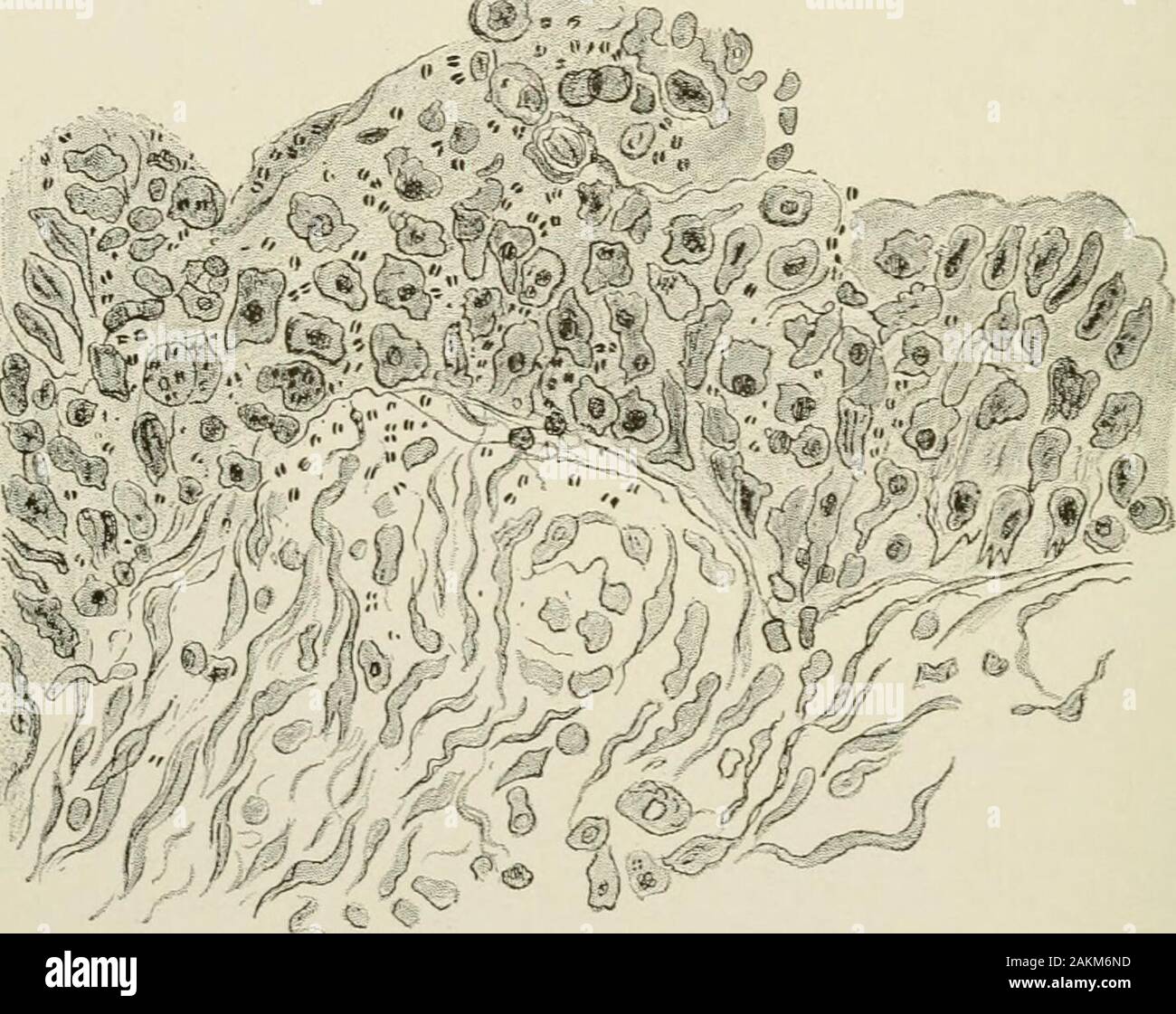 Gonorrhea discharge hi-res stock photography and images - Alamy