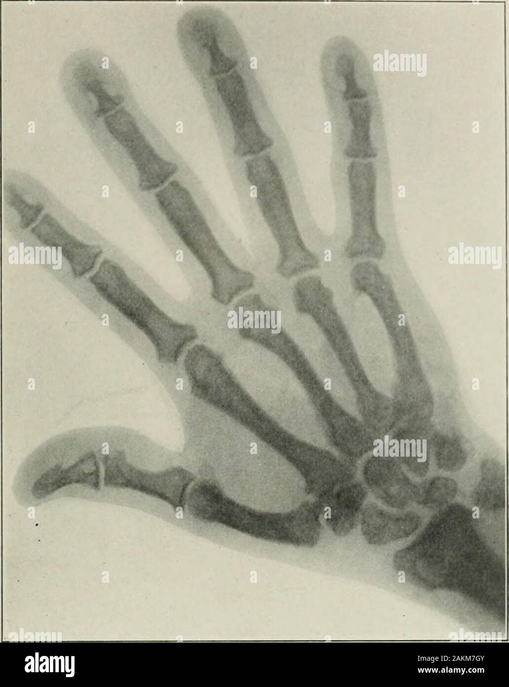 Osteophytes hi-res stock photography and images - Alamy