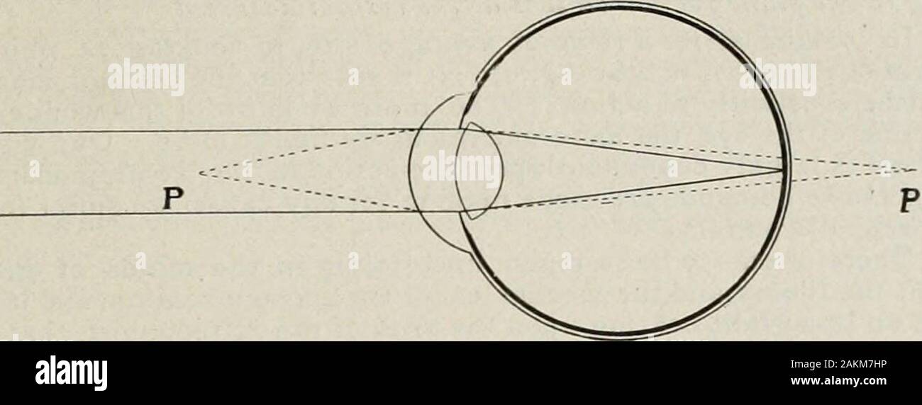 Contracted pupil eye hi-res stock photography and images - Alamy