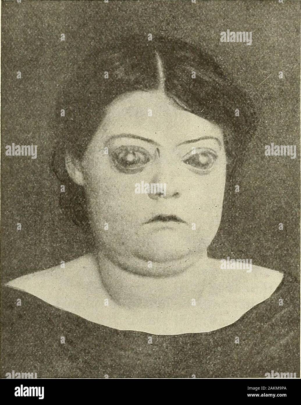 Toxic goiter hi-res stock photography and images - Alamy