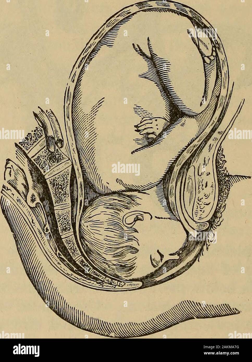 Caput succedaneum hi-res stock photography and images - Alamy