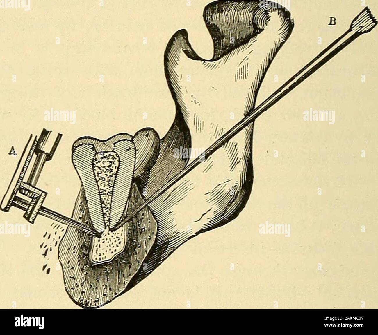 Broken abscess hi-res stock photography and images - Alamy