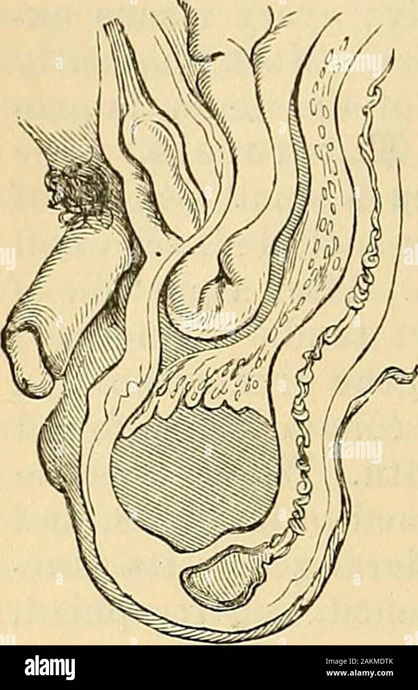 Hernial sac hi-res stock photography and images - Alamy