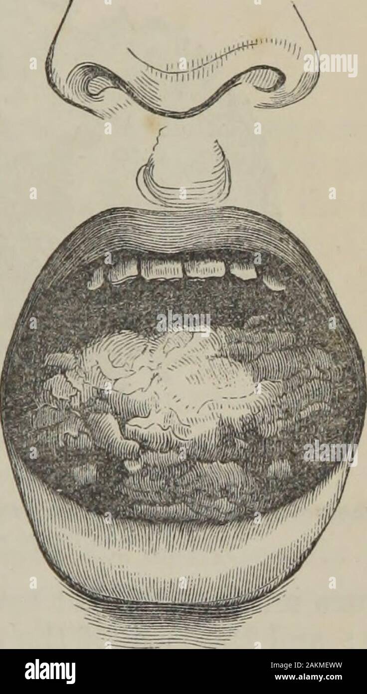 Ulcerating hi-res stock photography and images - Alamy