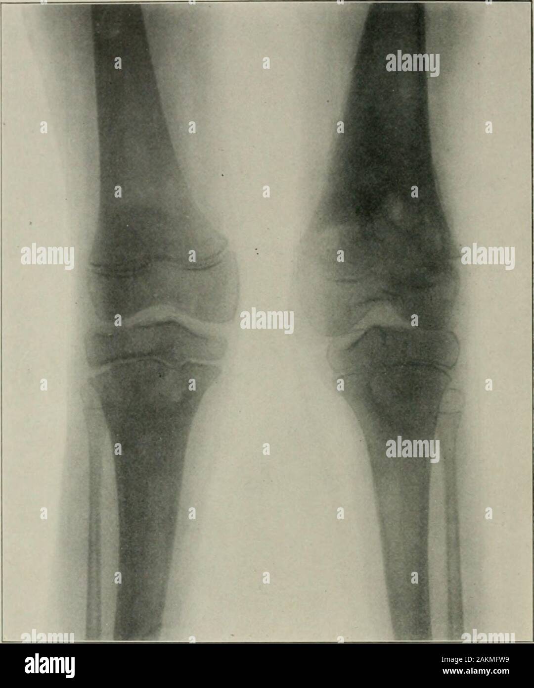 Tophi hi-res stock photography and images - Alamy