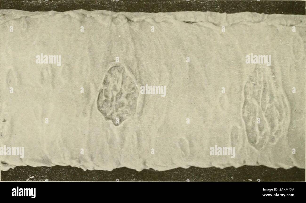 Phlegmonous hi-res stock photography and images - Alamy