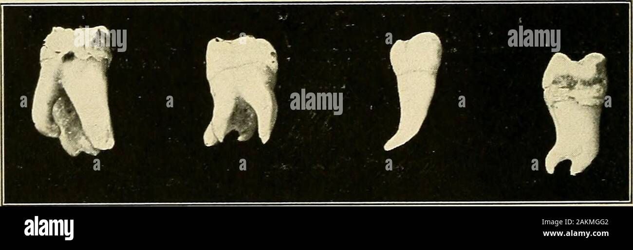 Principles and practice of operative dentistry . Fig. 555.—Inferior ...