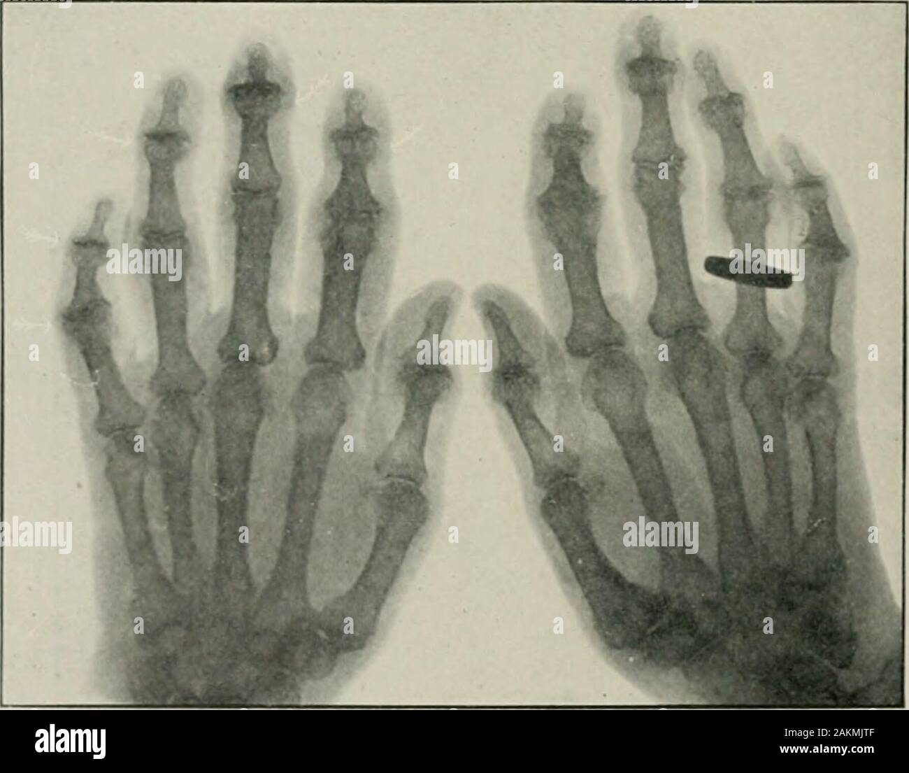 Surface erosions hi-res stock photography and images - Alamy