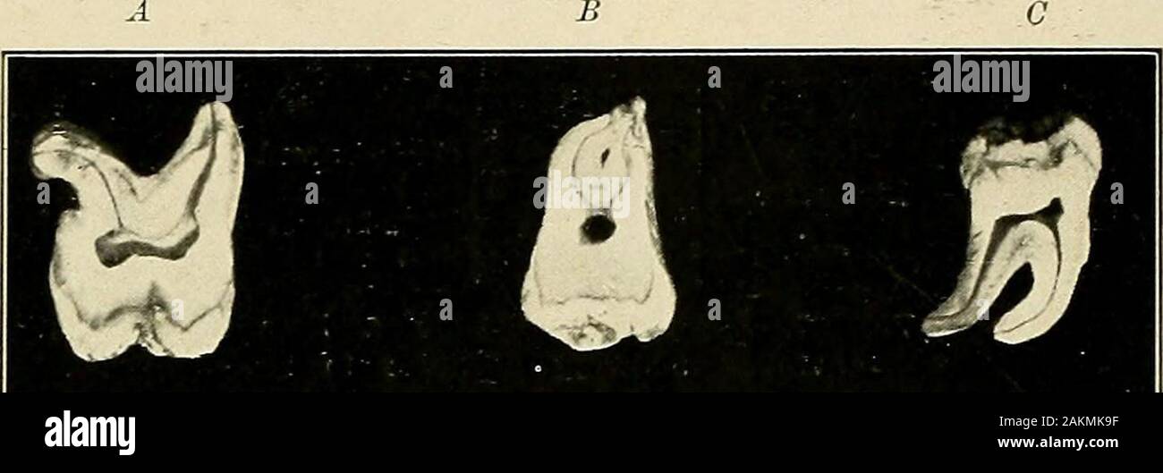 Principles and practice of operative dentistry . Mesio-buccalroot Fig ...