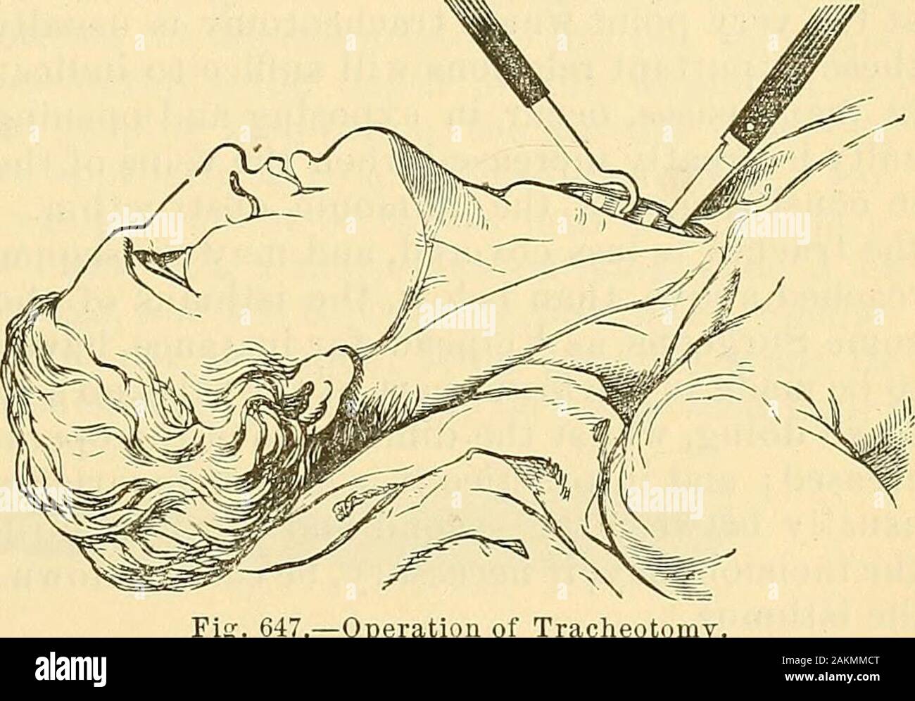 Chloroform administration hi-res stock photography and images - Alamy