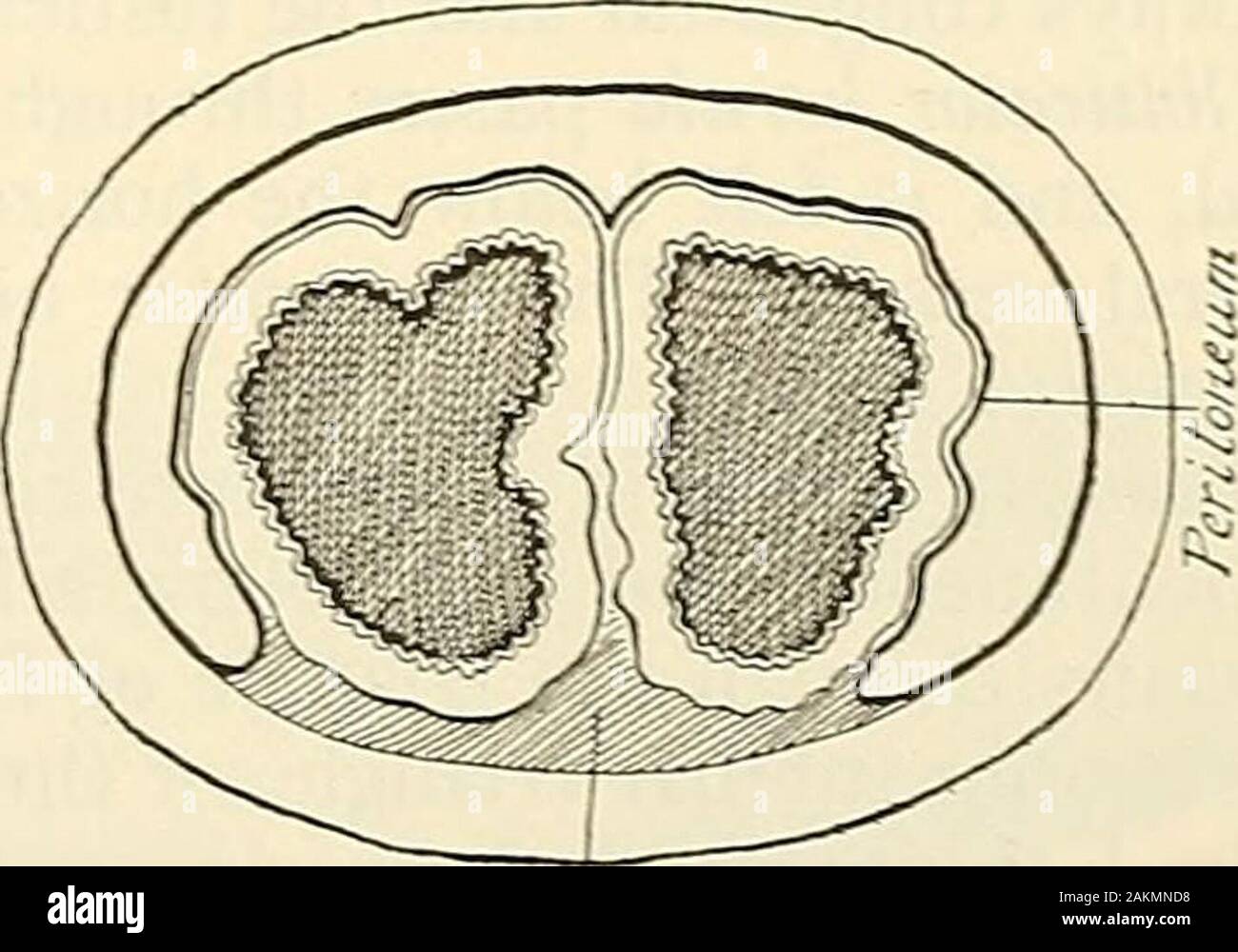 Modern surgery, general and operative . Fig. 76S.—The large intestine ...