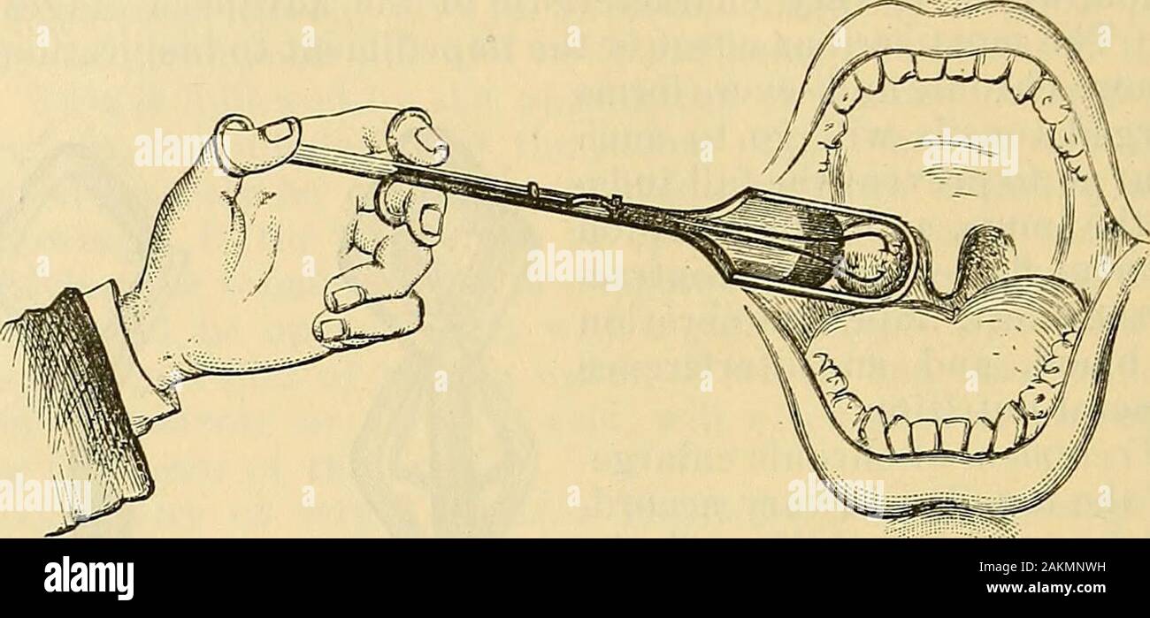 Tonsil drawing hi-res stock photography and images - Alamy