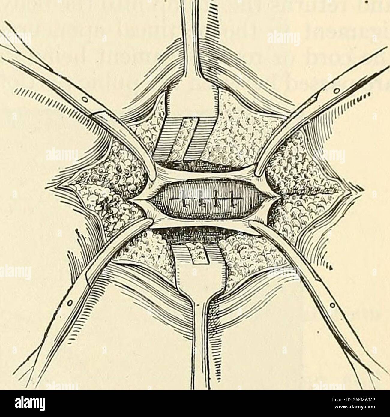 Modern surgery, general and operative . Fig- 754-—Mayos operation for ...
