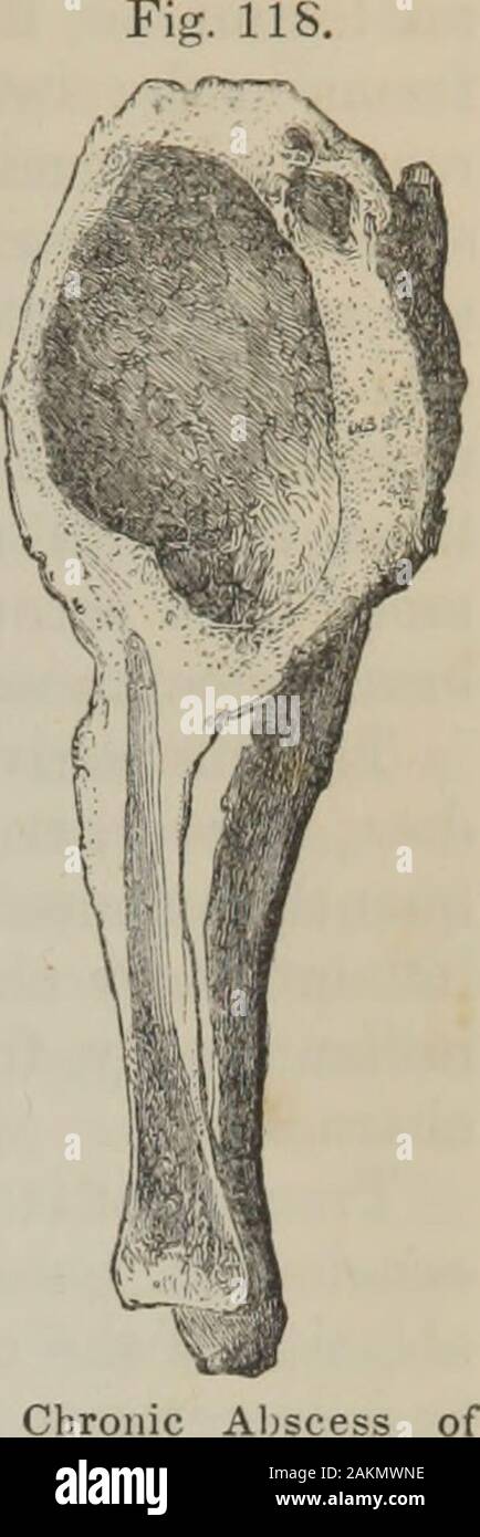 Ooze pus hi-res stock photography and images - Alamy