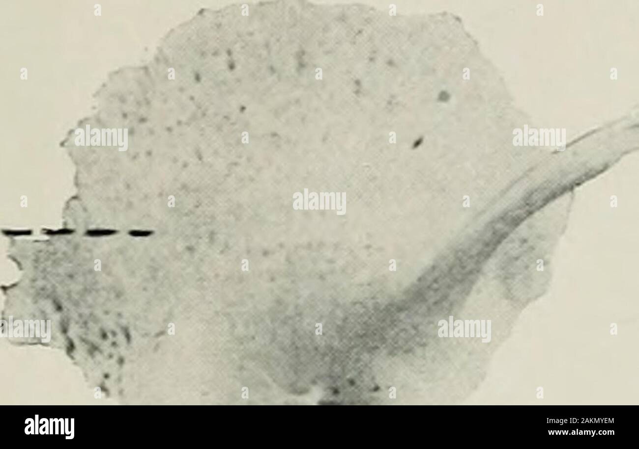 Tympanic membrane perforation hi-res stock photography and images - Alamy