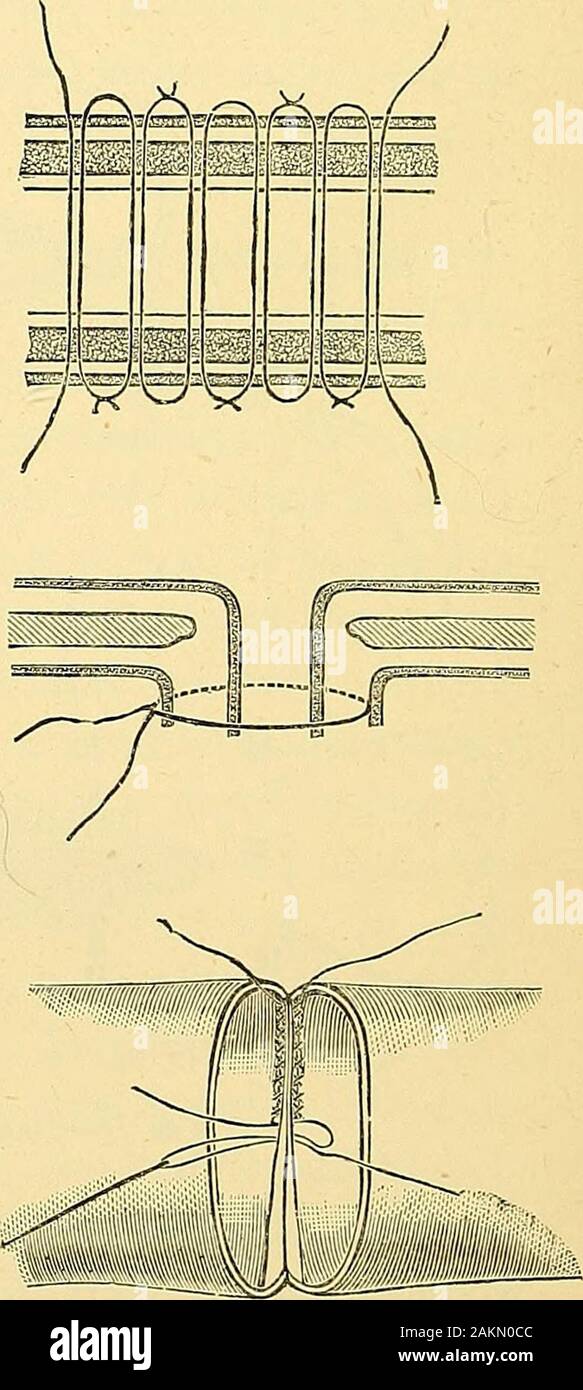 Distension abdominal hi-res stock photography and images - Alamy