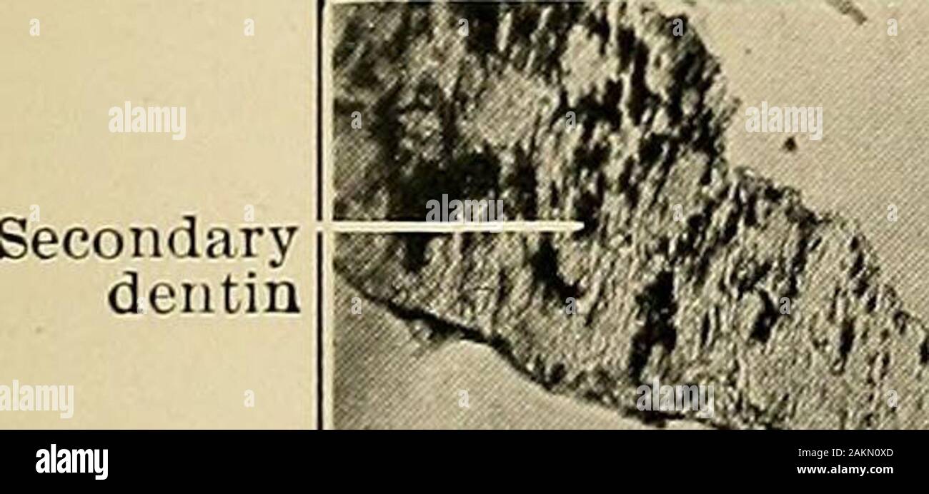 Pulp chamber hi-res stock photography and images - Alamy