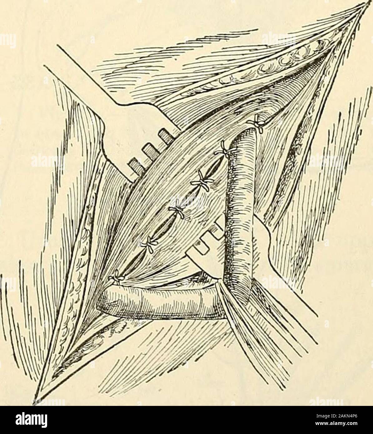 Ligament inguinal hi-res stock photography and images - Alamy