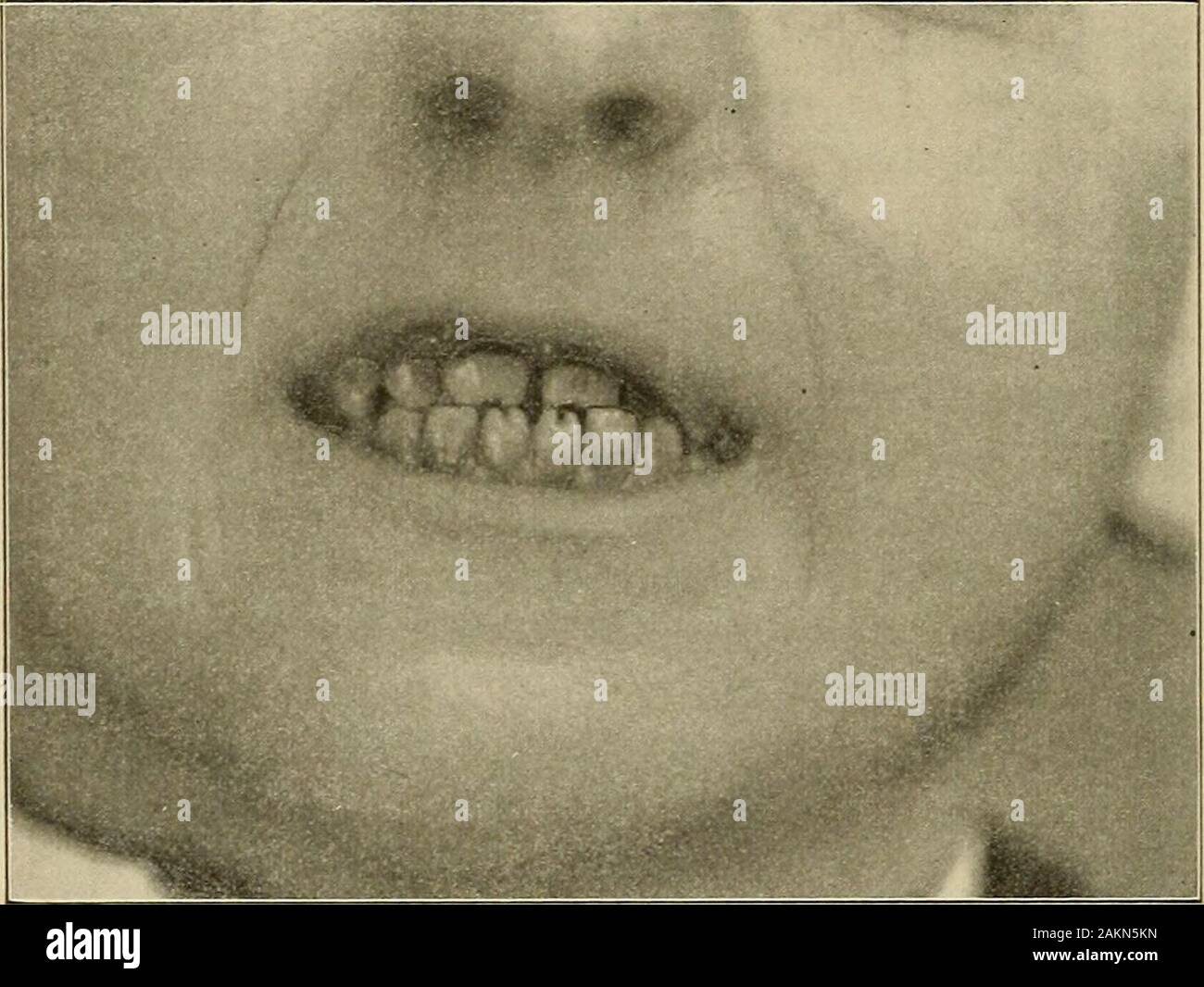 A manual of syphilis and the venereal diseases, . ded by most ...