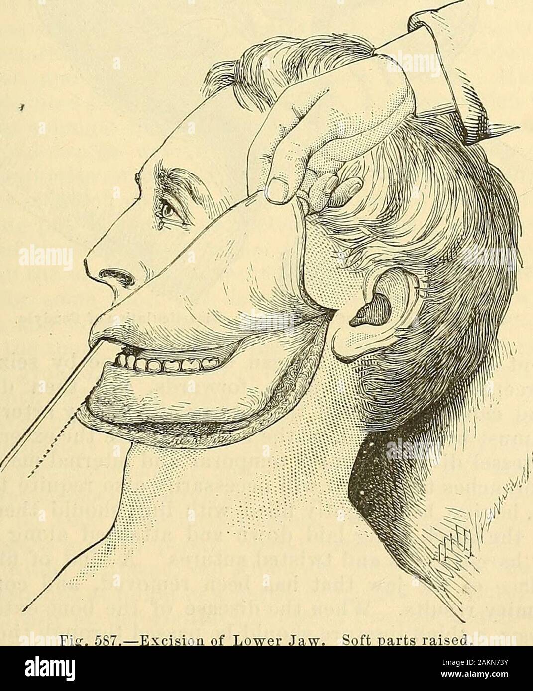 Jaw bone tumor hi-res stock photography and images - Alamy