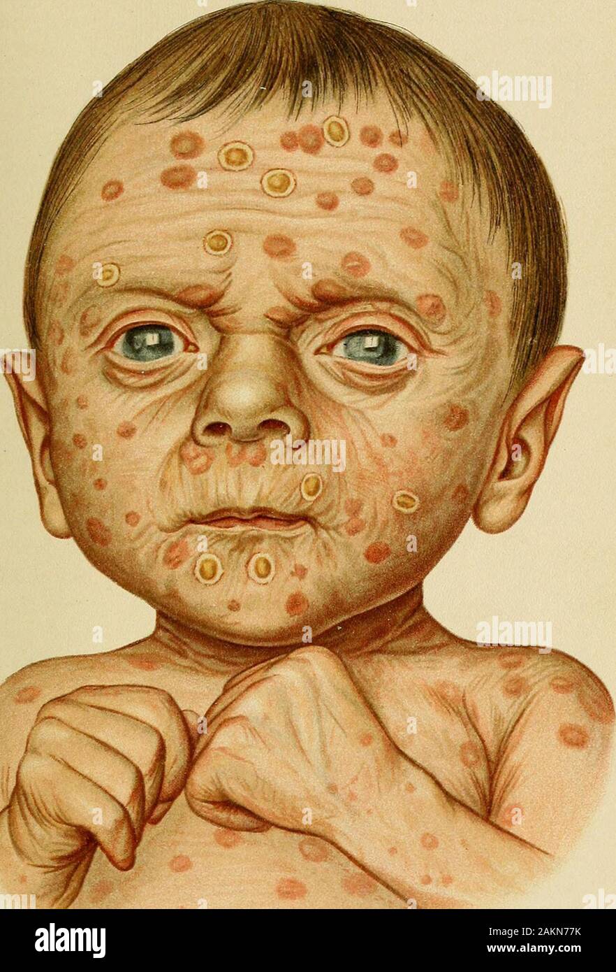 Venereal Syphilis