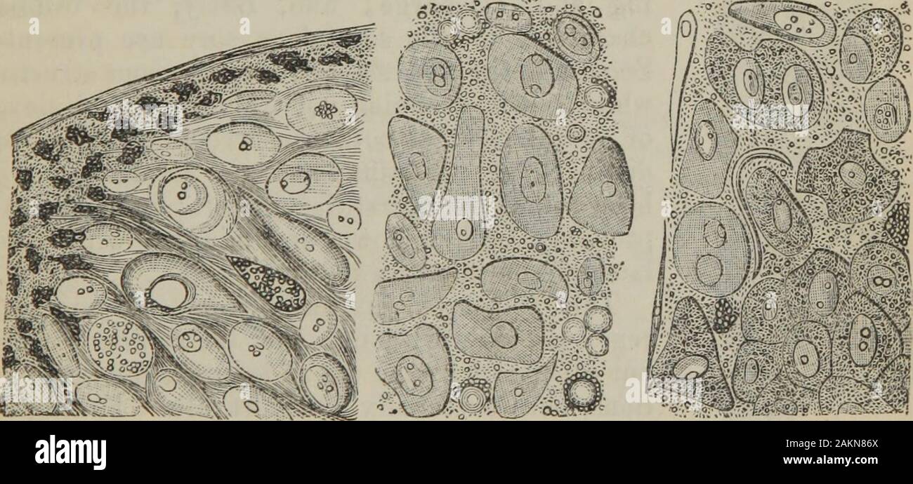 Simple cysts hi-res stock photography and images - Alamy