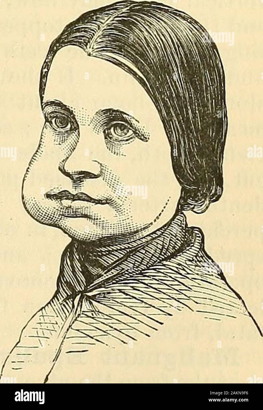 Epulis hi-res stock photography and images - Alamy