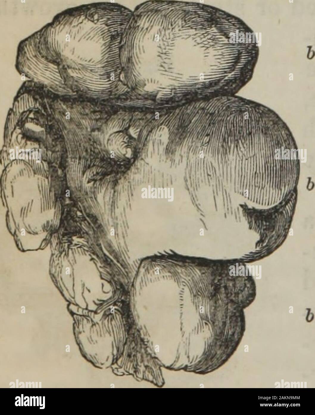 Neck abscess hi-res stock photography and images - Alamy