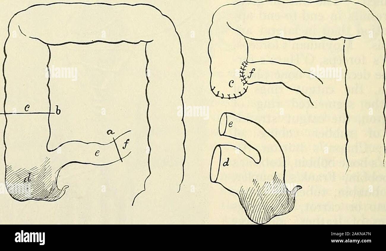 Intestinal fistula hi-res stock photography and images - Alamy